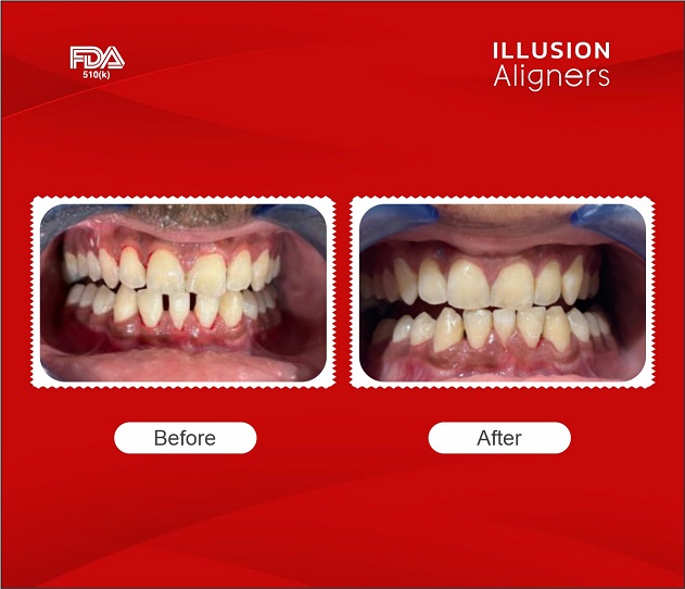 Midline Diastema Treatment with Illusion Aligners | Case Study