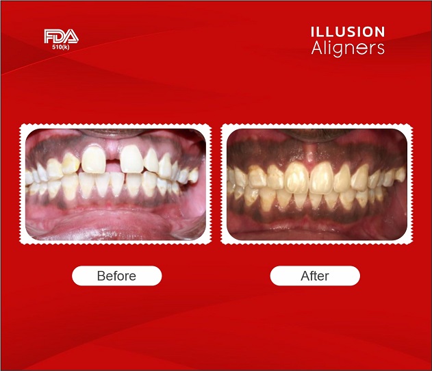 Midline Diastema Treatment with Illusion Aligners | Case Study