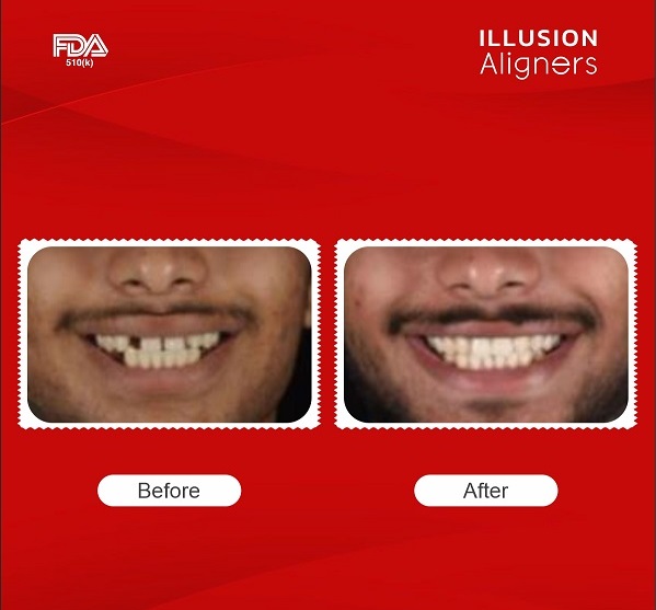 Smile Correction Treatment - Clear Aligners Case Study