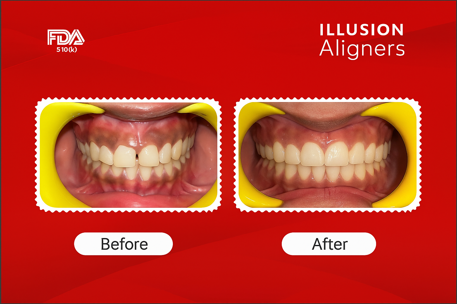 Gap in Front Teeth Closed with Illusion Aligners | Case Study
