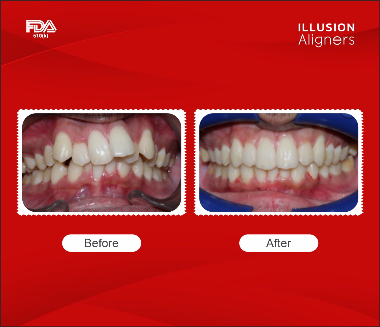 Clear Aligners Case Studies | Real Smile Transformations
